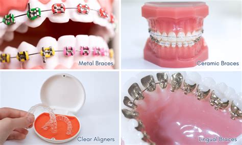 How To Fix An Overbite Braces Aligners And Non Braces Options