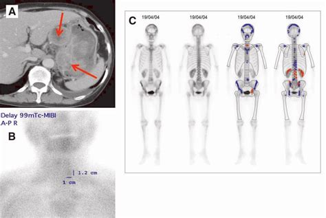 Abdominal Ct Mibi Scintigraphy And Bone Scintigraphy After Download Scientific Diagram