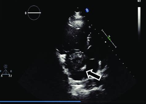 Two Dimensional Echocardiography Large Thrombus In The Right Atrium