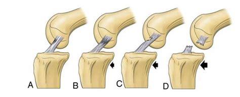 Lesões Ligamentares No Joelho Dr Oliver Ulson Traumatologia Ortopedica