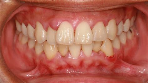 Boala Gingiilor Simptome Cauze Si Tratamente