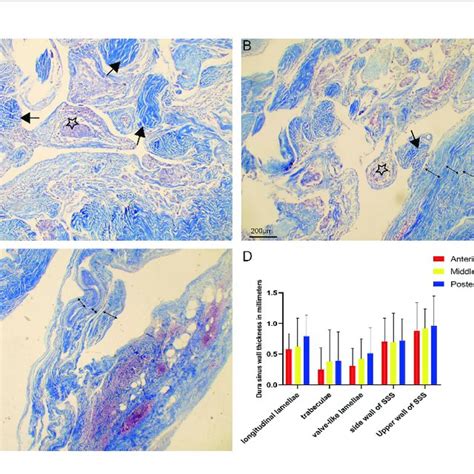 Three Types Of Arachnoid Granulation In The Superior Sagittal Sinus Download Scientific