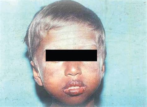 Genodermatoses Derm Boards Flashcards Quizlet