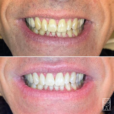 Blanchiment dentaire à Paris les traitements chez Paris Dental
