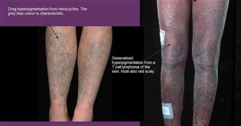 Dermatology Made Simple Hyperpigmentation Generalised