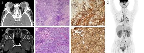 Igg4 Related Dacryoadenitis A D And Malt Lymphoma E G A Ct Scan Download Scientific
