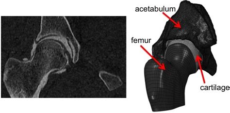 Whole Hip Joint Finite Element FE Modeling Mobile Biomechanics Lab Cal Poly San Luis Obispo