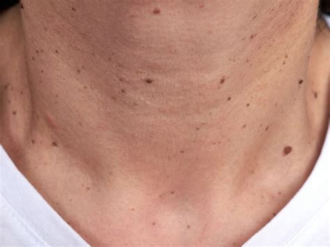 Por qué salen verrugas en el cuello qué hacer si no desaparecen