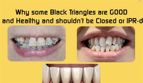 Black Triangles Arent Always Bad