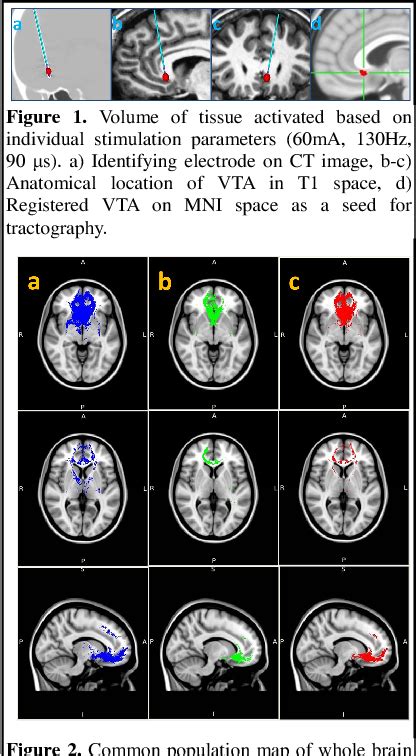 Figure 1 From Optimizing Subcallosal Cingulate Dbs For Treatment