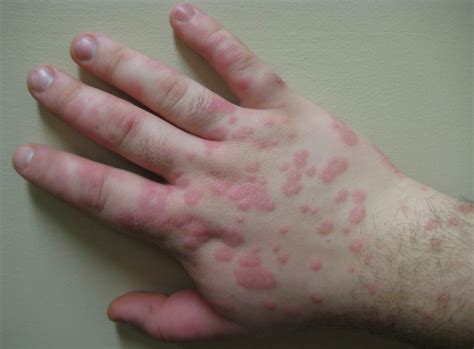 Eritema Multiforme Penyebab Gejala Dan Cara Mengobati IDN Medis