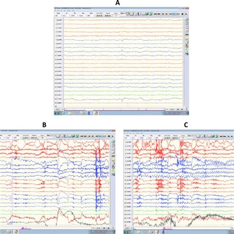 Interictal Eeg Revealed Sharp Waves Detected In The Right Anterior