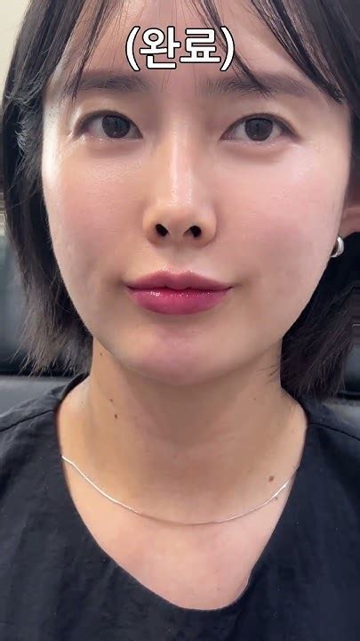 자연 볼륨 입술필러 입꼬리필러 시술전후 입술필러 입꼬리필러 시술후기 Shorts Youtube