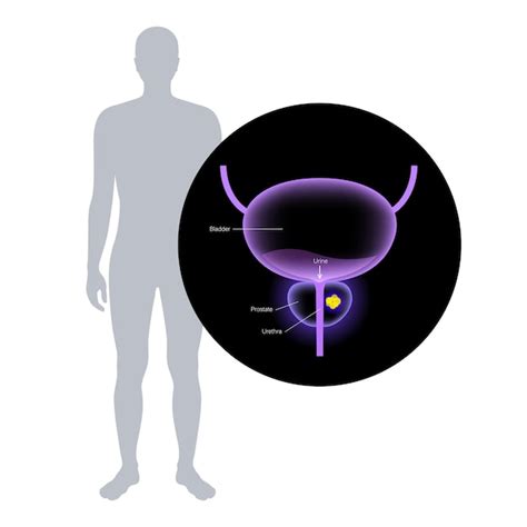 Premium Vector Prostate Cancer Concept
