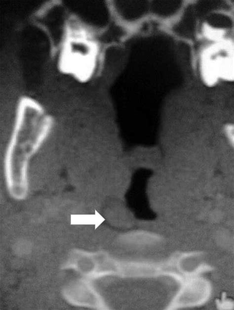 Diagnostyka różnicowa guzów na tylnej ścianie gardła u dzieci Nowa Pediatria
