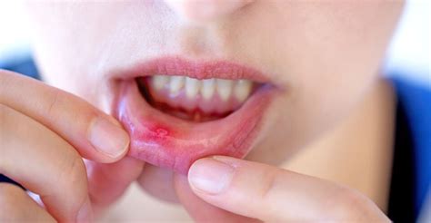 口内炎の種類とその原因は？食事や生活習慣を見直して予防しよう｜楽しむ・学ぶ｜養命酒製造株式会社