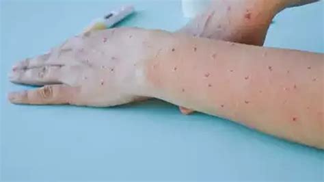 लगातार बढ़ रहे Mpox के मामले Who ने कहा ड्रॉपलेट्स के जरिए कम फैलता