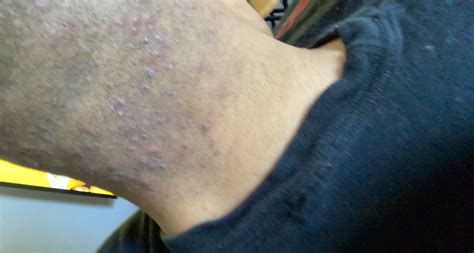 Pimples Or Zits On Back Of Scalp Backbodyneck Acne Forum