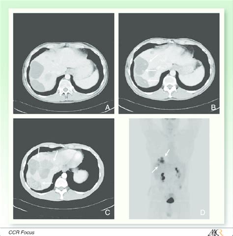 Development Of Multiple Imatinib Resistant Clonal Nodules In A Gist Download Scientific Diagram