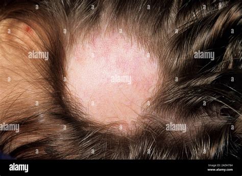 Alopecia Bald Spot On The Scalp Of A 7 Year Old Girl Due To Alopecia