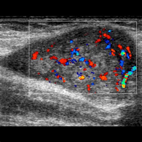Nerve Sheath Tumors Radiology Key