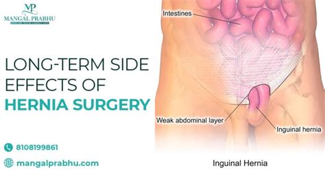 Know The Long Term Side Effects Of Hernia Surgery
