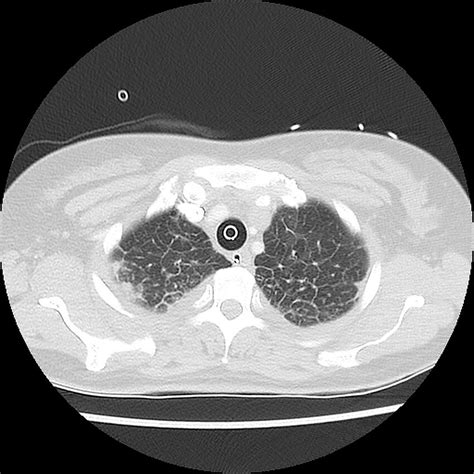 Acute Pulmonary Edema On Ct Radiopaedia 33582 34672 Axial Lung Window Nc Commons