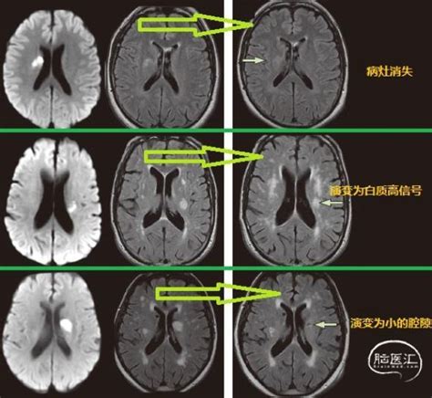 腔隙灶、v R间隙、缺血灶、腔梗灶、梗死灶、软化灶、脑白质脱髓鞘、脑白质疏松、脑白质高信号等等，你能分的明明白白吗？ 脑医汇