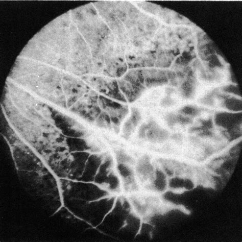 Low Power Photomicrograph Of Retina Case 2 Shows Extensive Area