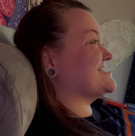 Splint Removed 6 Weeks Po Djs Genio R Jawsurgery