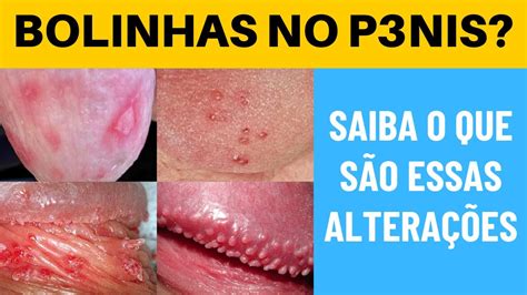 Manchas Vermelhas Na Glande O Que Pode Ser Librain