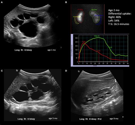 Radiological History Of An Infant With Resolution Of Severe
