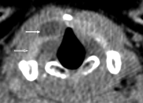 The Corresponding Axial Non Contrast Ct Scan Shows That The Lesion Is