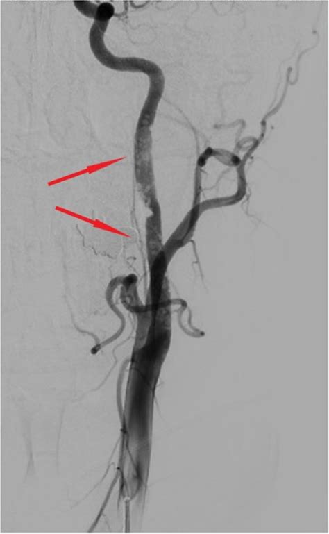 Digital Subtraction Angiography Dsa Shows A Insect Bite Like Changes
