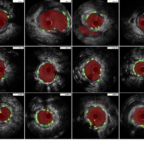Examples Of Strut Detection In Ivus Images Where The Automatic Download Scientific Diagram