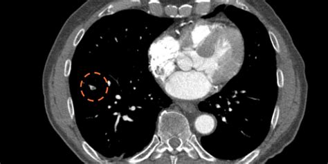 Artificial Intelligence In Routine Chest Ct Improves Detection Of