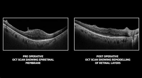 Epiretinal Membrane Oct