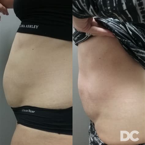 Trusculpt® 3d Fat Reduction Body Contouring Winnipeg Victoria Park