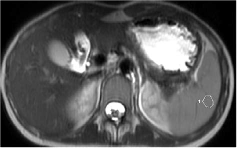 Demonstration Of Spleen Intensity Calculation On The Axial T2 Weighted