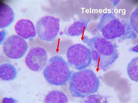 eritroblasto basófilo Fuente Club de Informática Médica y Flickr