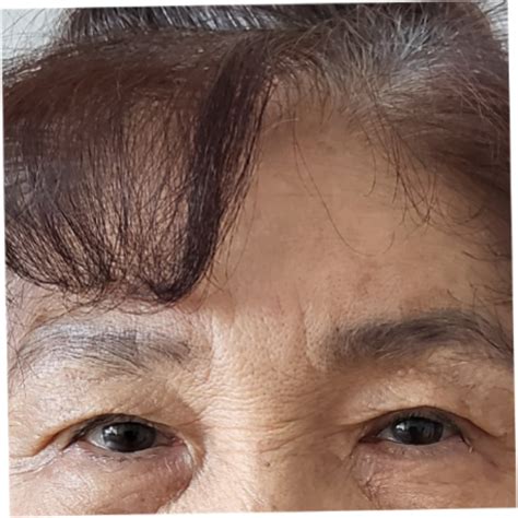 75세 비절개 쌍꺼풀 후기 1mm성형외과