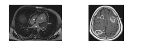 Four Chamber Axial Phase Sensitive Inversion Recovery Sequence View Download Scientific