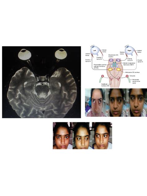 Webino Syndrome Wall Eyed Bilateral Internuclear Ophthalmoplegia