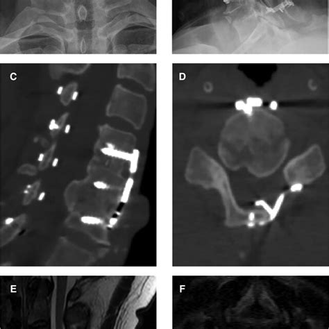 Peak Spinal Cord Von Mises Stress During Extension Before And After 1