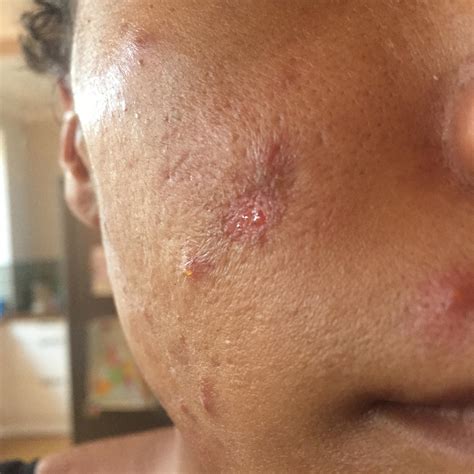 Serous Fluid Pimple