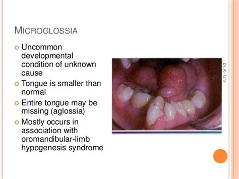 Developmental Oro Facial Disturbances Part Ii