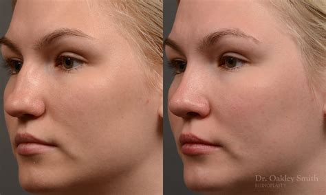 408d Rhinoplasty Dr Oakley Smith Toronto Top Surgeon Nose Job Toronto Rhinoplasty Surgery