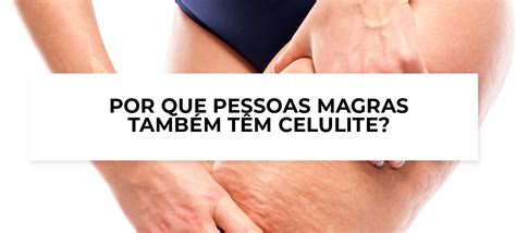 Porque pessoas magras também têm celulite Blog Ada Tina