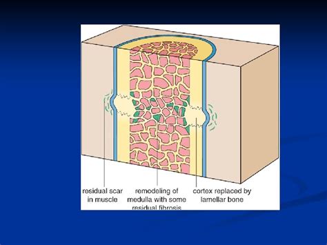 Musculoskeletal Block Pathology Lecture 1 Fracture And Bone