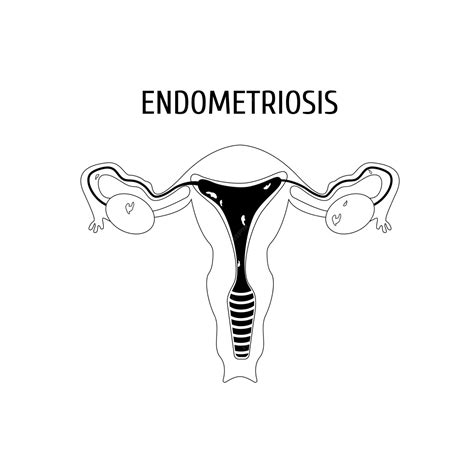 Esquema De Genitales Femeninos Endometriosis Vector Premium